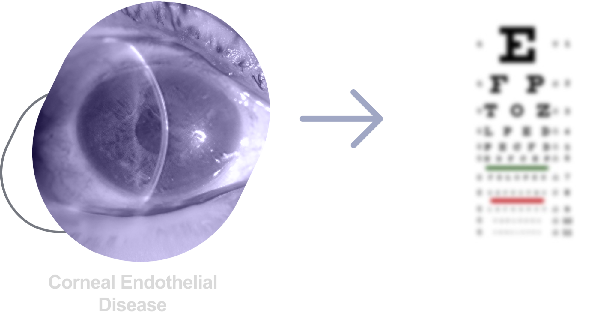 Endothelial Disease - Aurion Biotech